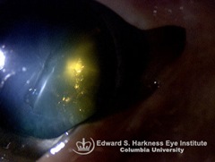Medicine Decoded: Cataracts-Few interesting types